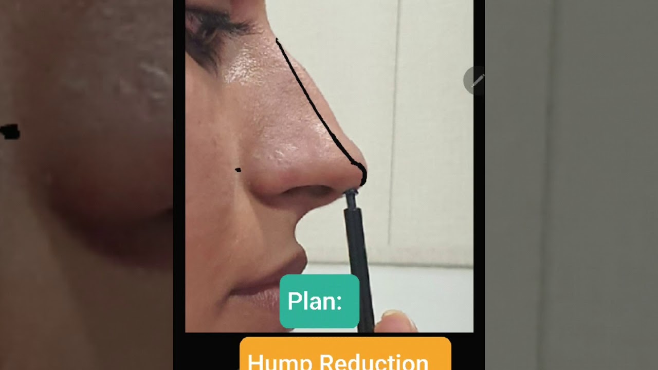 Best nose job surgery in Pakistan | Dr Arfat Jawaid - YouTube