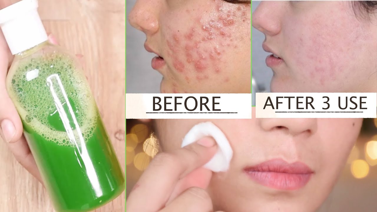 I applied this for 3 DAYS on Pus filled ACNE & PIMPLES and this is what ...