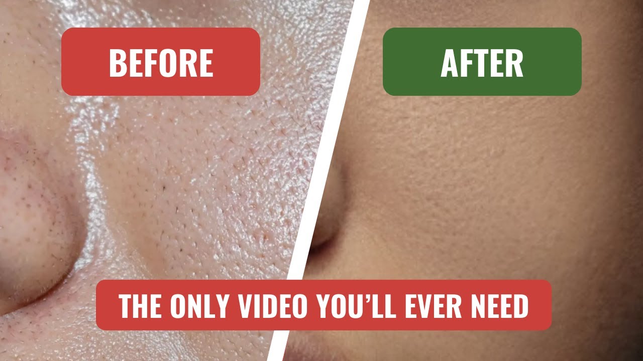 How to Reduce Sebum Production | The Proven Ways to Reduce Excess Skin ...