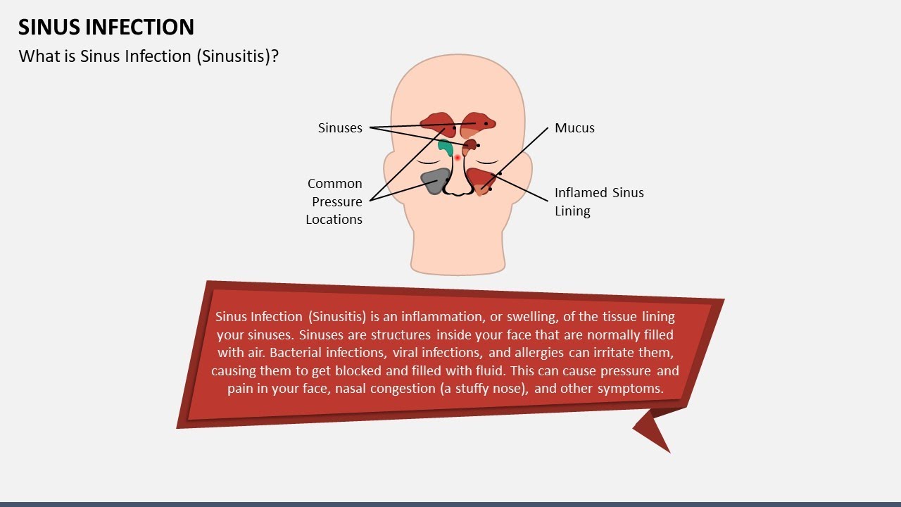 Sinus Infection Animated PowerPoint Slides - YouTube