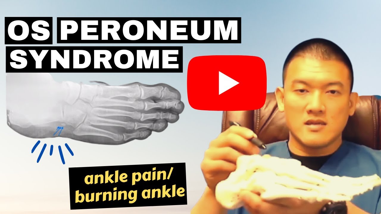Unstable ankle, pain / burning lateral ankle: Os peroneum | Florida ...