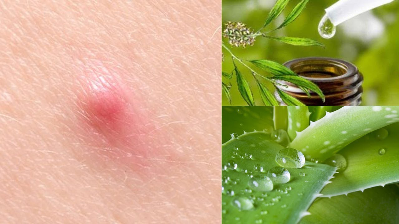 Beseitigen Talgzysten mit natürlichen Heilmittel | Gesundheit - YouTube