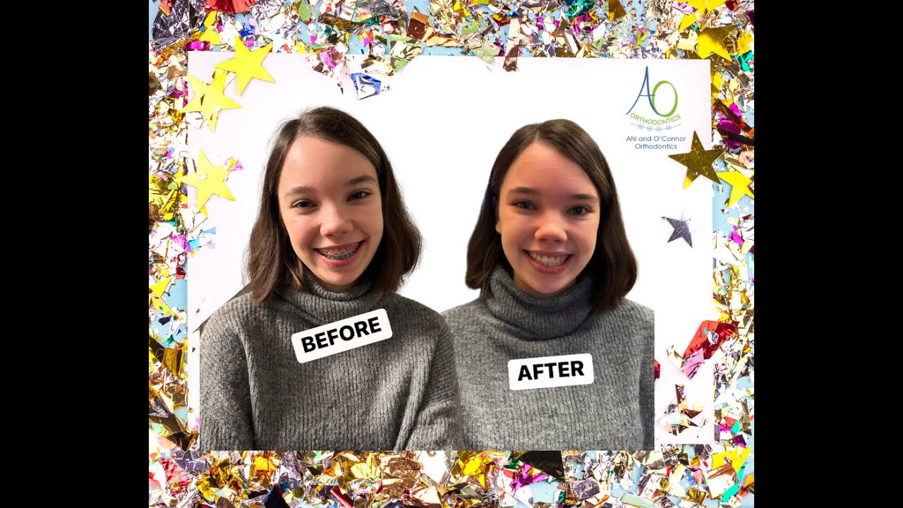 What to Expect During Debond - YouTube