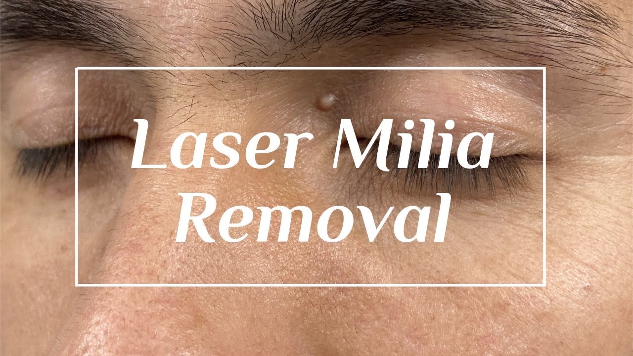Milia Removal - YouTube