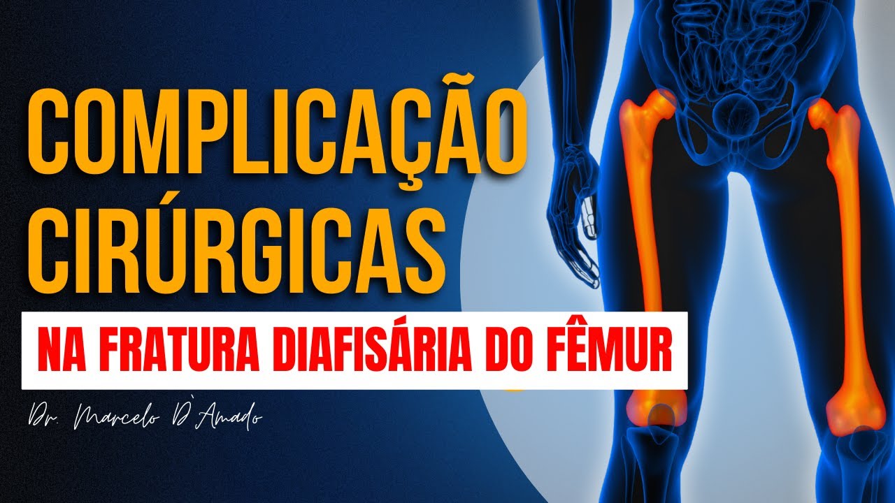 COMPLICAÇÕES COMUNS NA FRATURA DIAFISÁRIA DE FÊMUR TRATADA COM HASTE ...