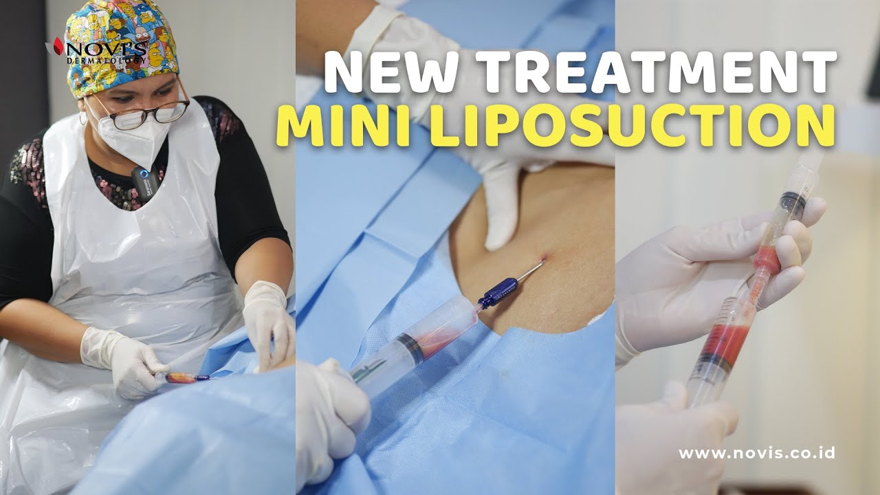 [ NEW TREATMENT ] Mini Liposuction || NOVI'S Dermatology - YouTube