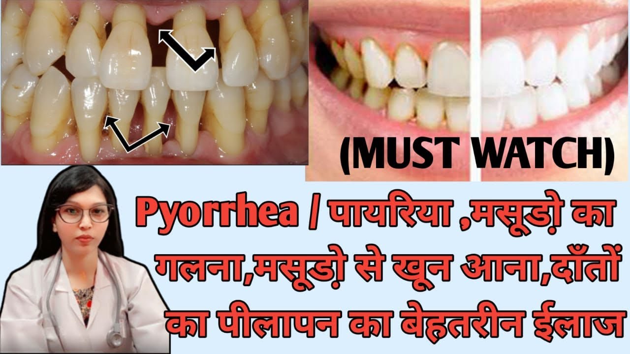 Homoeopathy medicine for pyorrhoea / pyorrhoea treatment / पायरिया का ...