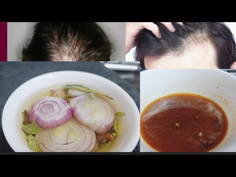 കഷണ്ടി മറന്നേക്കൂ വെളിച്ചെണ്ണ–സവാള മാജിക്ക് (ആശ്ചര്യപ്പെടേണ്ട)#Baldness ...