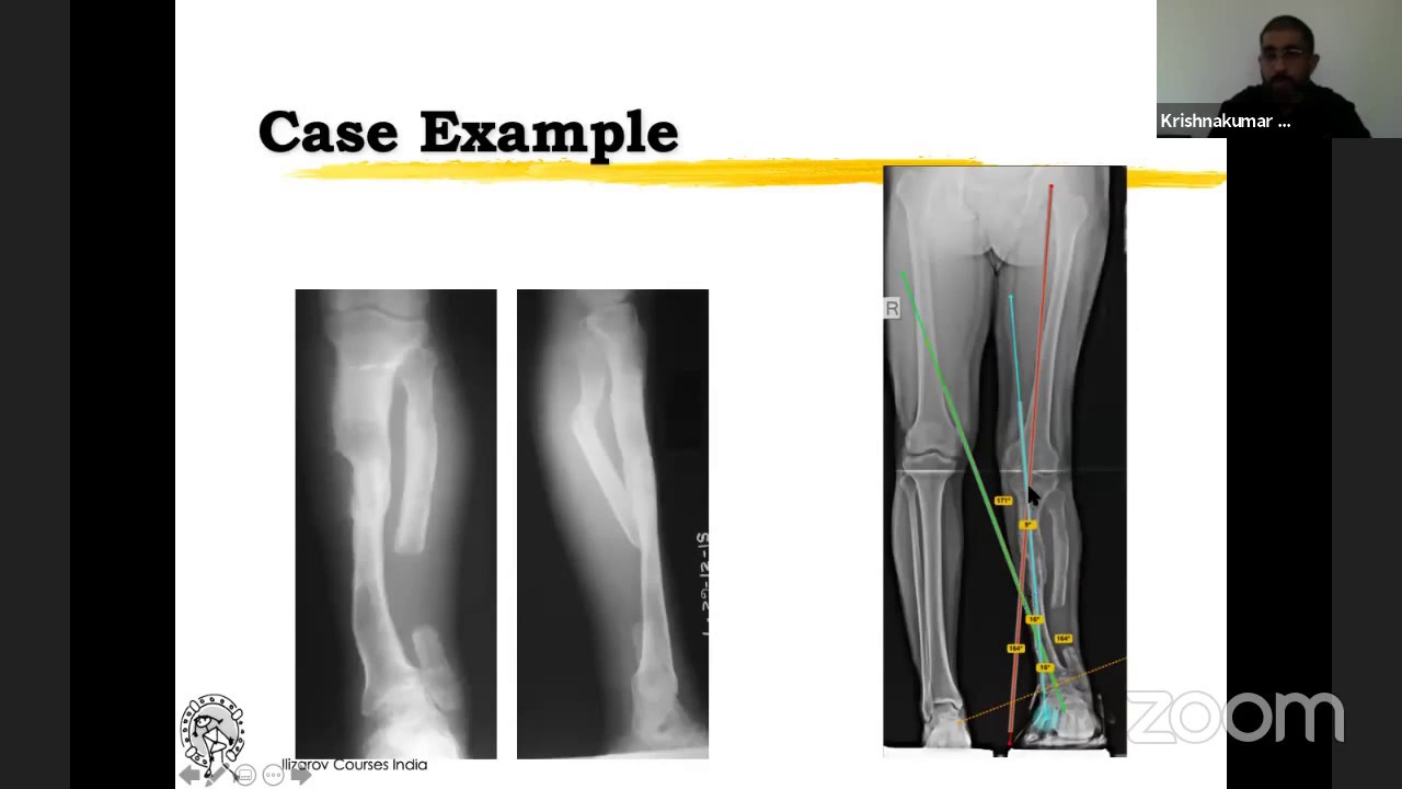 Principles of Sagittal Plane and MultiApical deformity Correction - YouTube