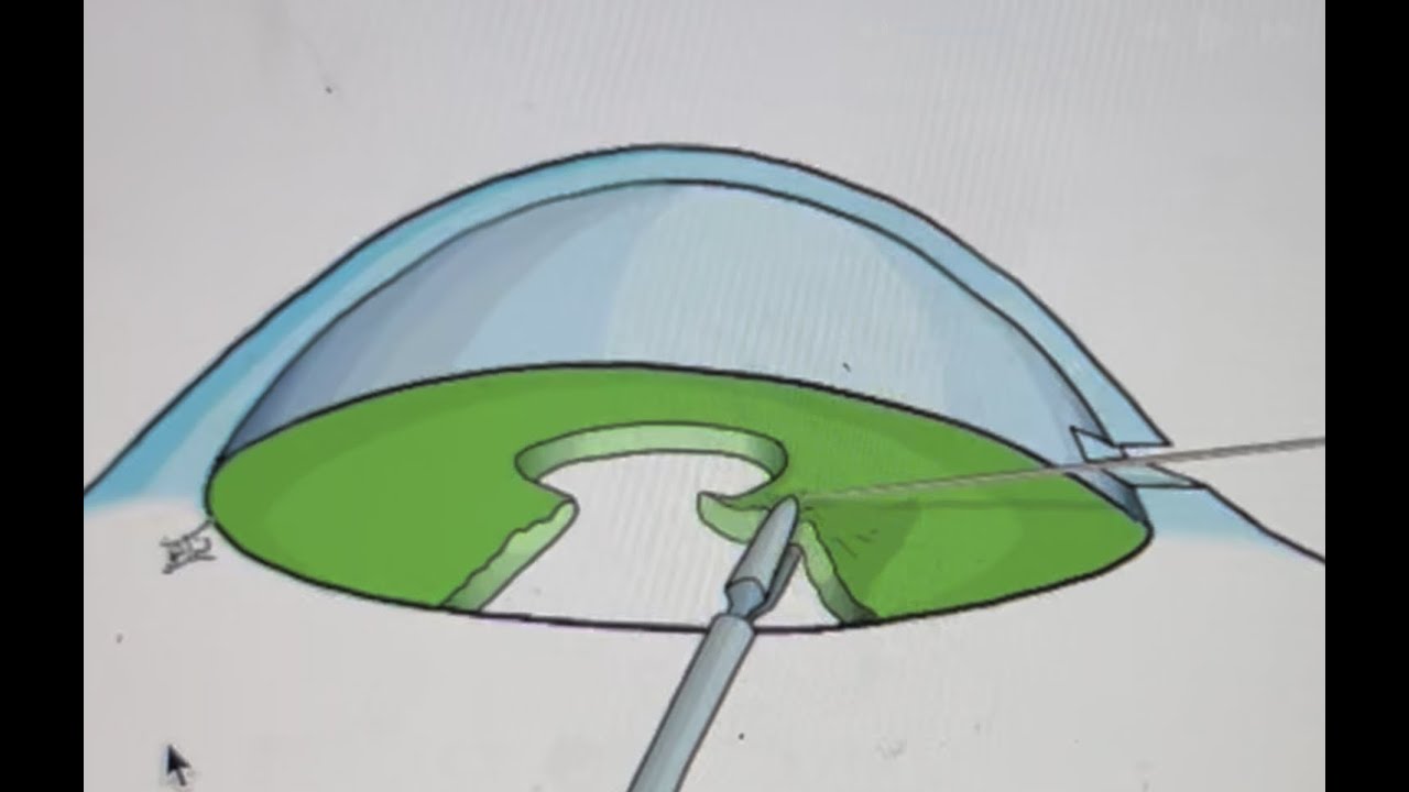 How to repair an iris defect after cataract surgery. Graphics by Dr ...