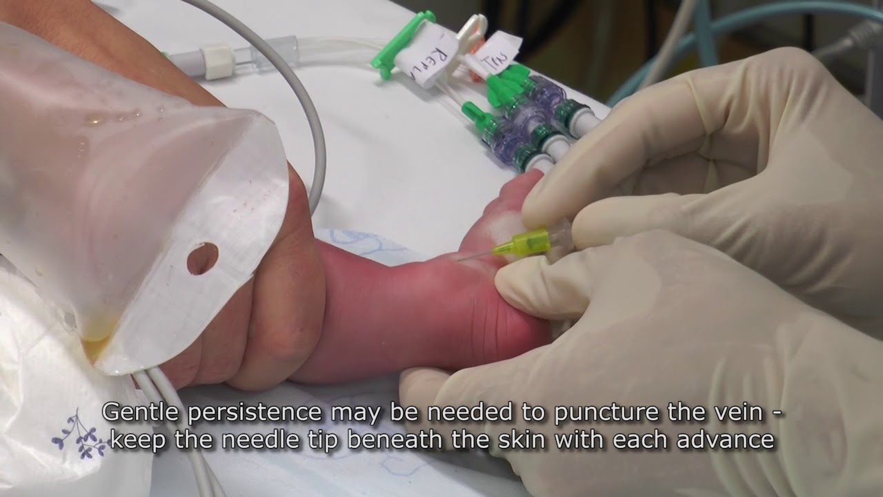 Paediatric Anaesthetics: Chapter 7 - Long saphenous IV neonate 1 - YouTube