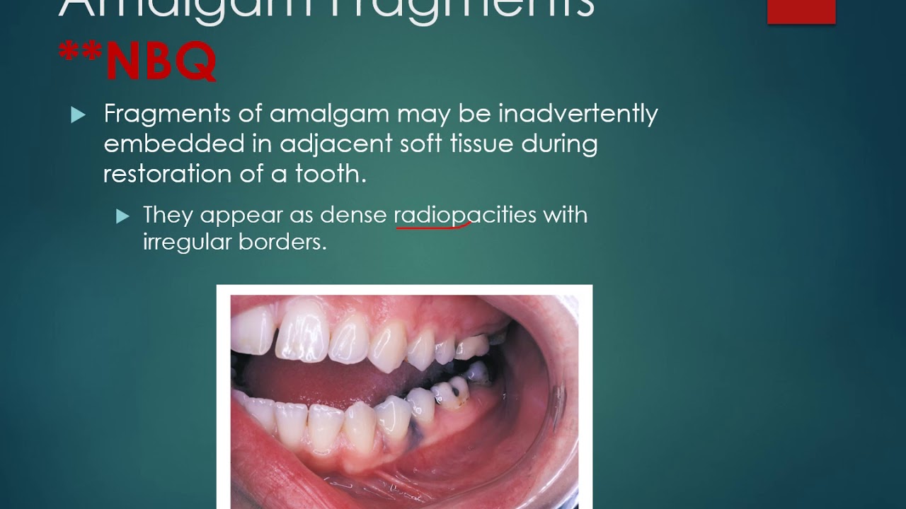 Dental Restorations, Materials, and Foreign Objects in Radiography ...