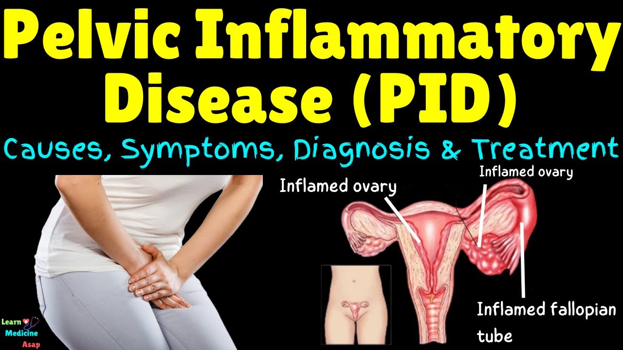 Pelvic Inflammatory Disease (PID) – Symptoms, Causes, Diagnosis ...
