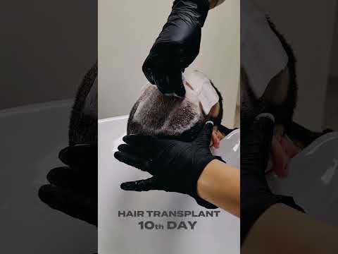 Saç ekimi saç yıkama 10. gün #saçekimi #hairtransplant #hairwashing