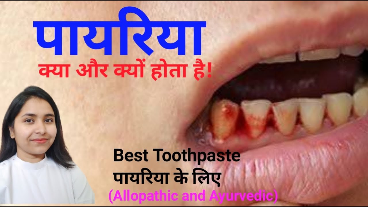 पायरिया क्या और क्यों होता है? पायरिया के लिए best toothpaste कौन सा है ...