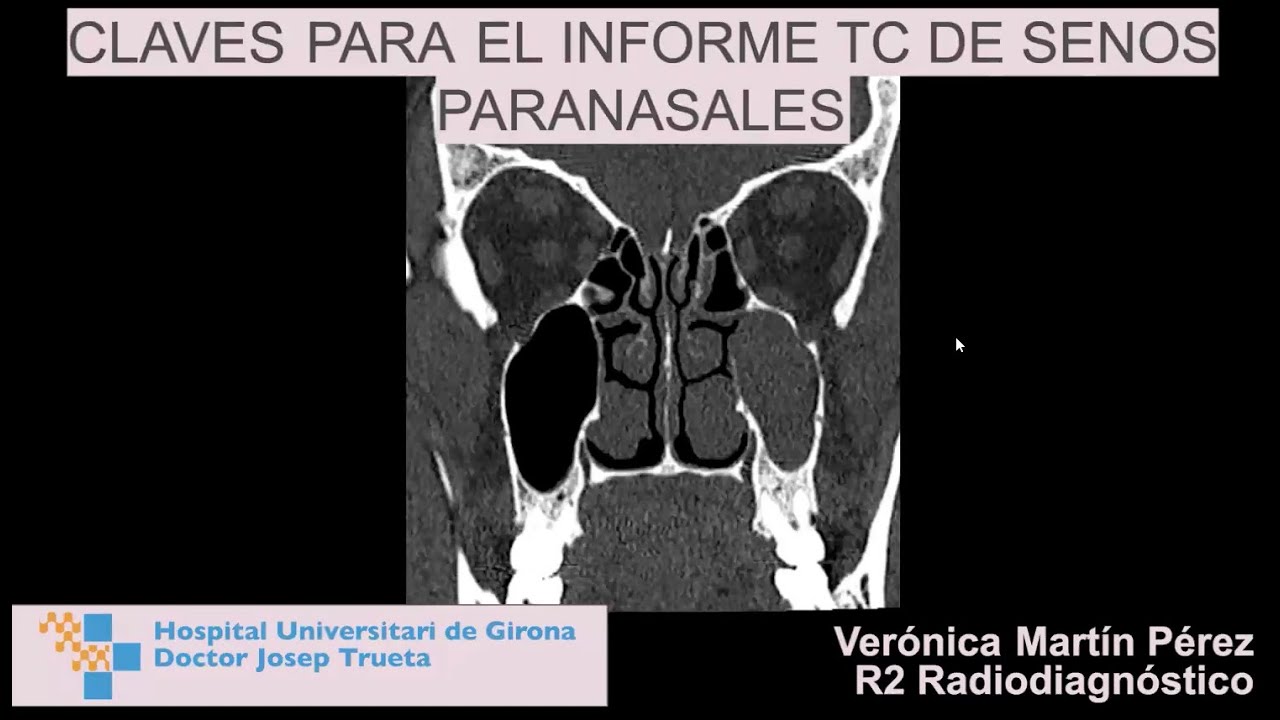 665- Claves para el informe TC de senos paranasales. Curso de ...