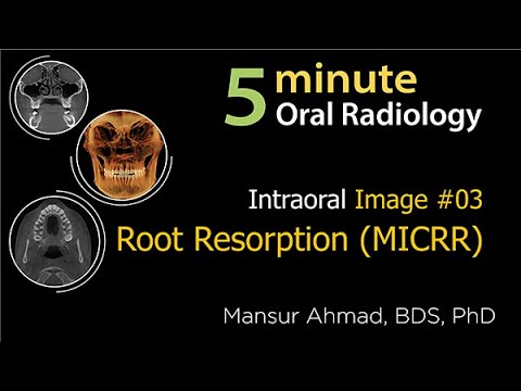 Cervical Root Resorption (MICRR): Intraoral Radiographic Interpretation ...
