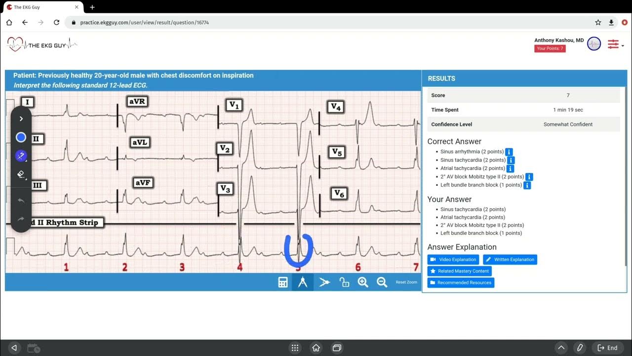 ECG Interpretation Case Walk-Thru | The EKG Guy - YouTube