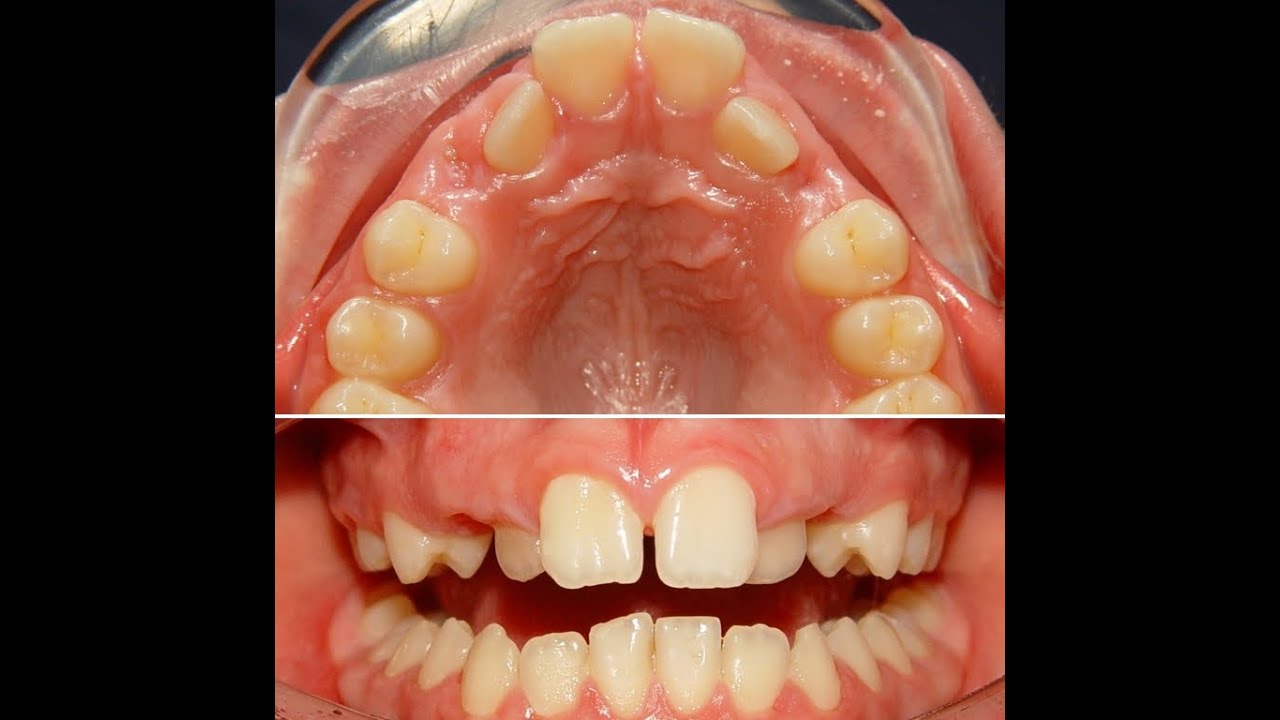 Orthodontic Treatment of Deep Impaction of Upper Canine - Yasmine 15yrs ...