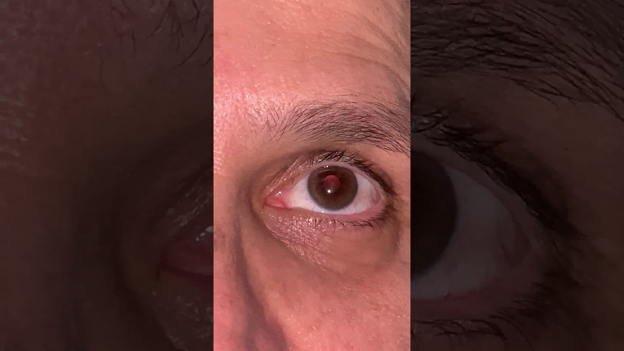 Reflejo rojo con un iphone - YouTube