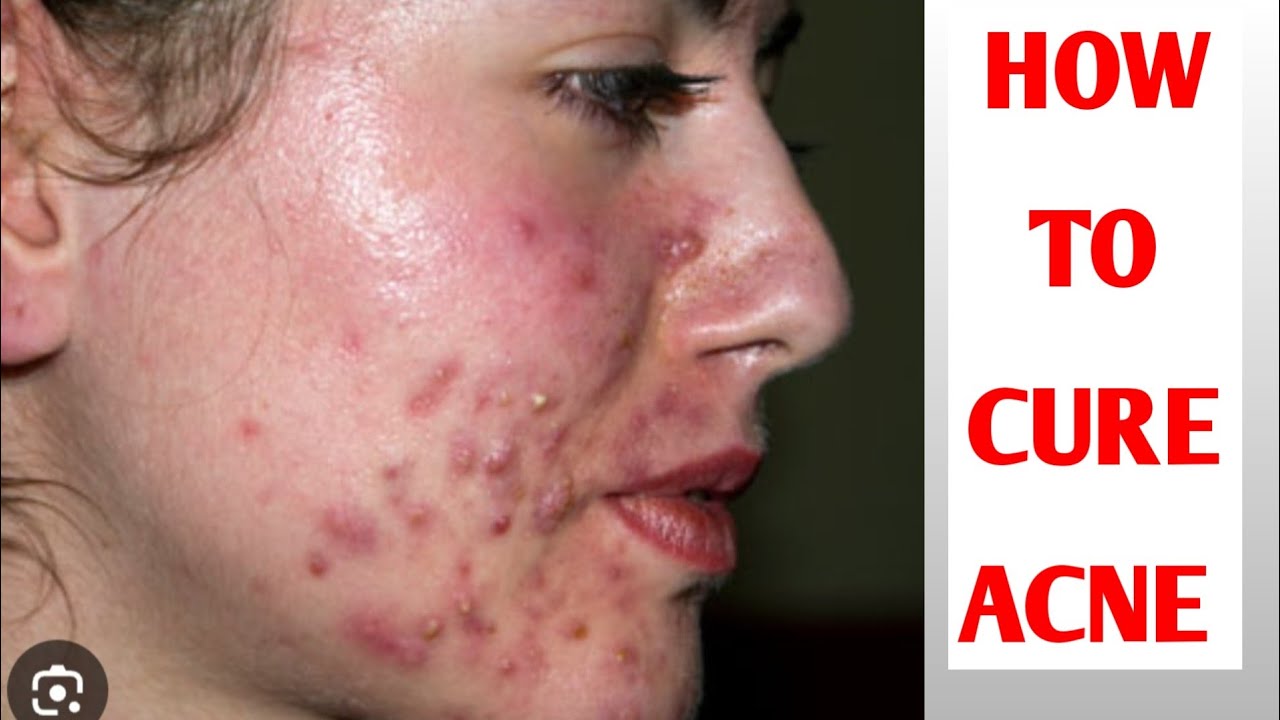 How To Really Get Rid Of Acne Texture Acne Scars Skin Damage | How To ...