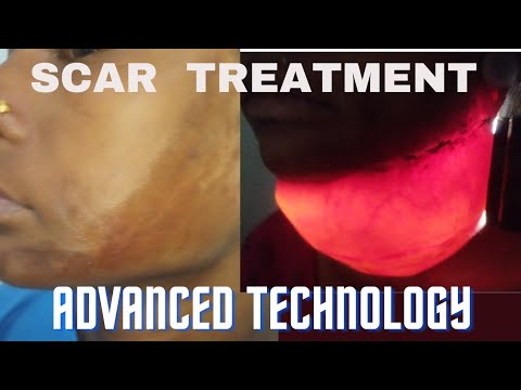 Scar treatment with advance device| scar treatment in Ranchi| Tissue ...