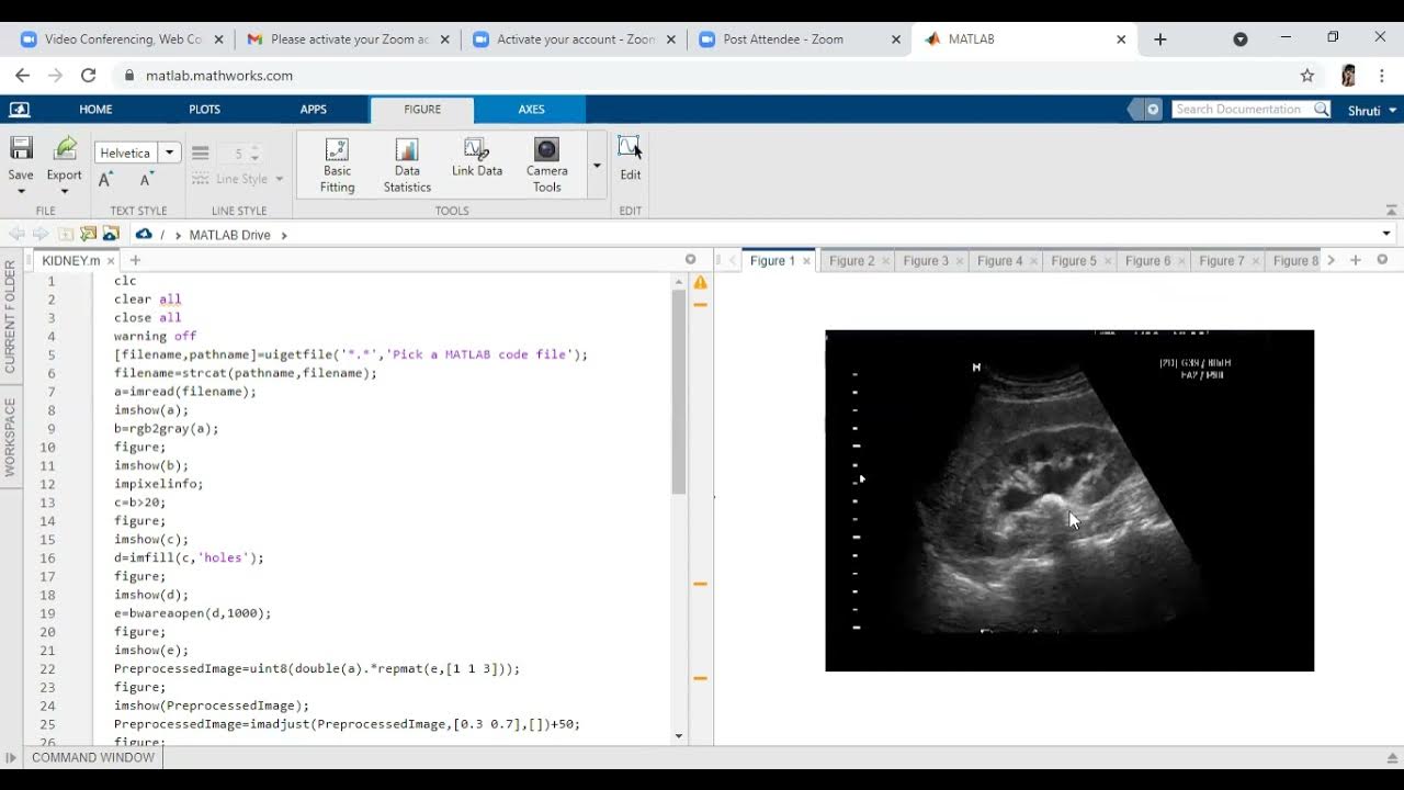 kidney stone detection using digital image processing - YouTube