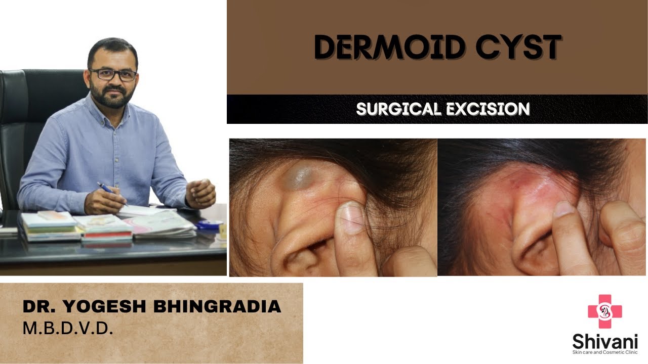 DERMOID CYST | SURGICAL EXCISION | DR YOGESH BHINGRADIA - YouTube
