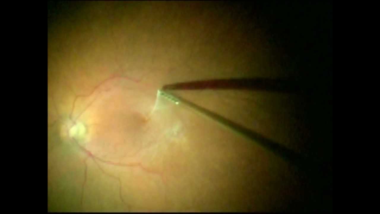 Vitrectomy Membrane Peeling