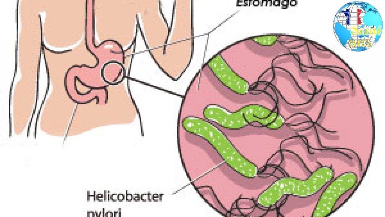 Cancer de l'estomac traitements - YouTube