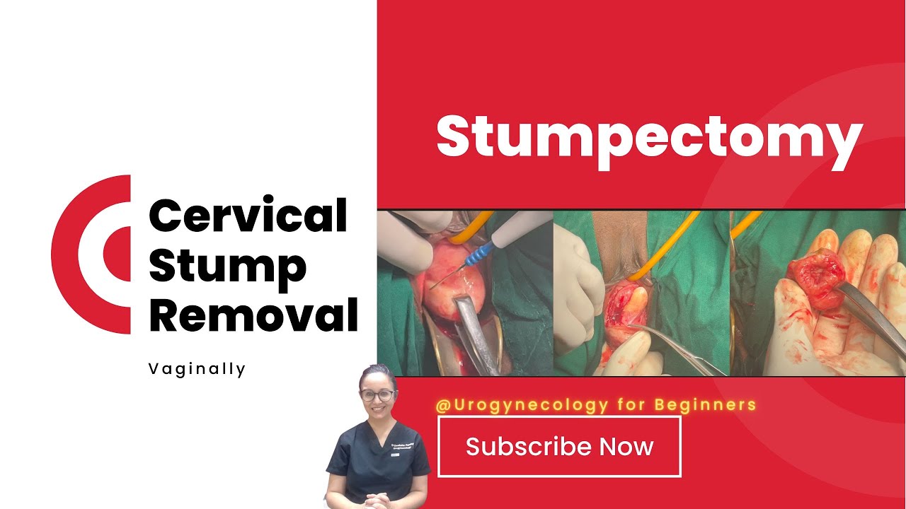 Cervical Stumpectomy | Cervical Stump Removal | Vaginal Route | Dr ...