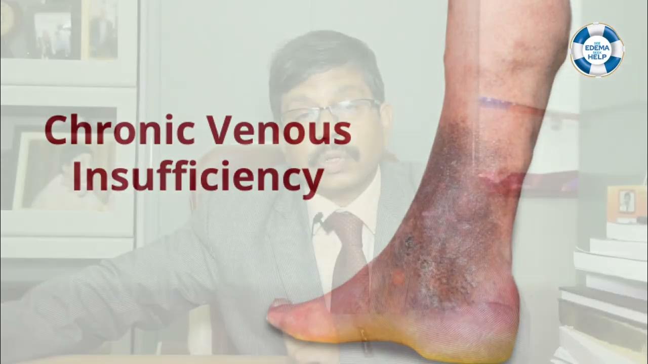 Know About Pedal Edema Causes Symptoms Treatment By Nephrologist Dr know-about-pedal-edema-causes-symptoms-treatment-by-nephrologist-dr