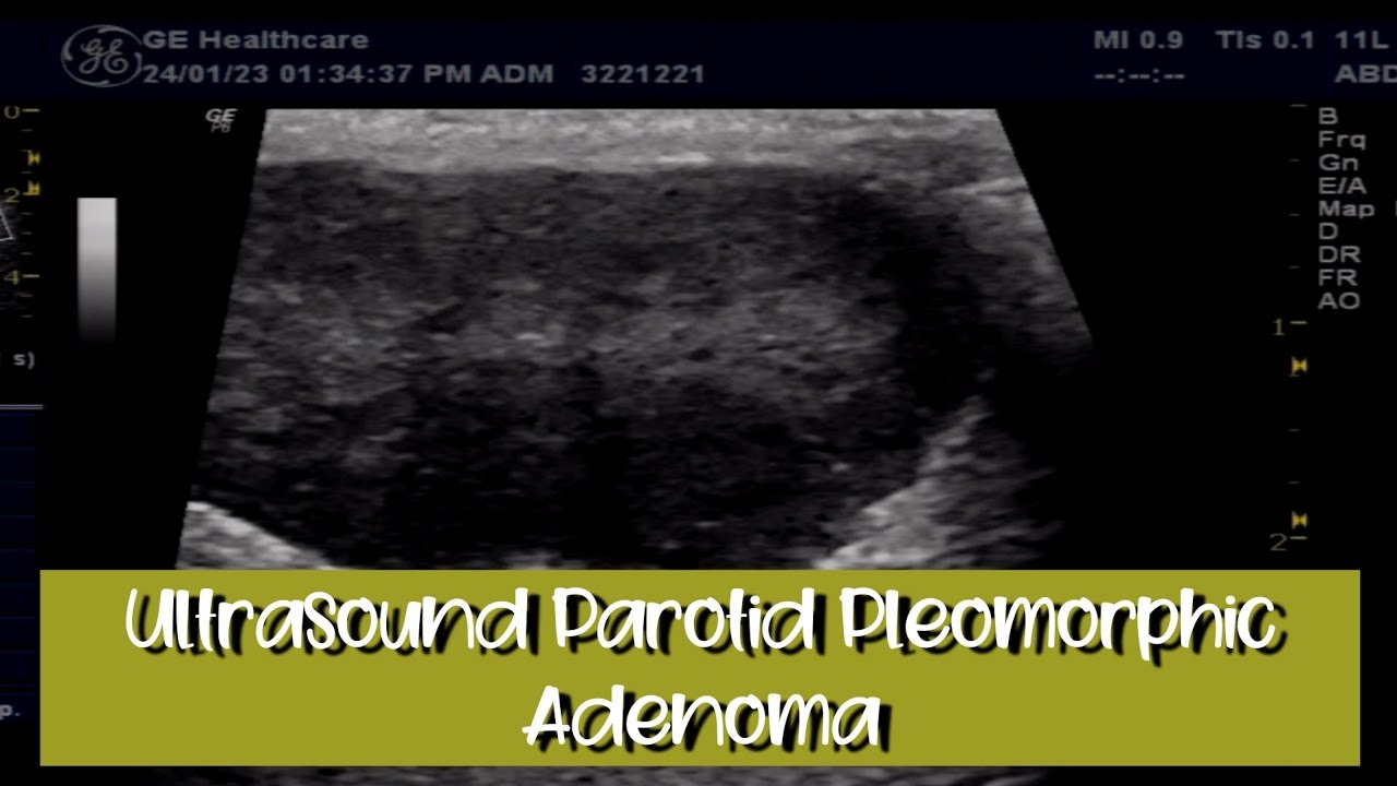 Ultrasound Parotid Gland Pleomorphic Adenoma || - YouTube