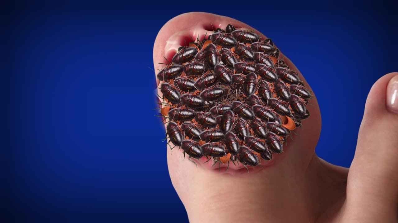 ASMR Foot Thumb Treatment Surgery | ASMR Kadu Maggots Infected Thumb ...