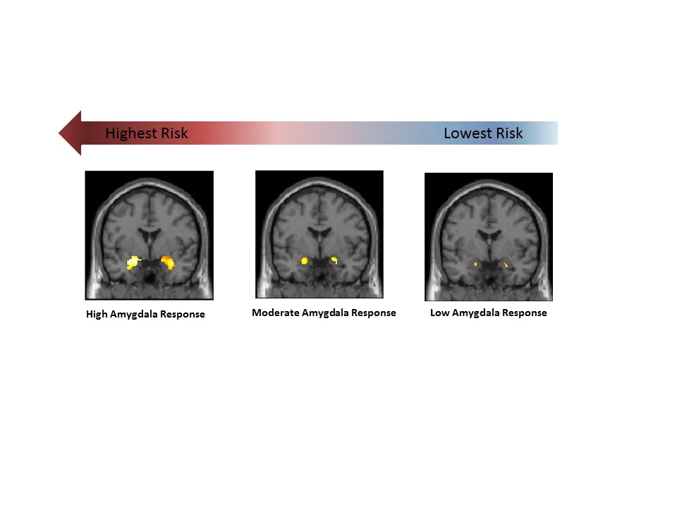 A Brain Marker Pinpoints Vulnerability for Future Life Stress {Duke ...