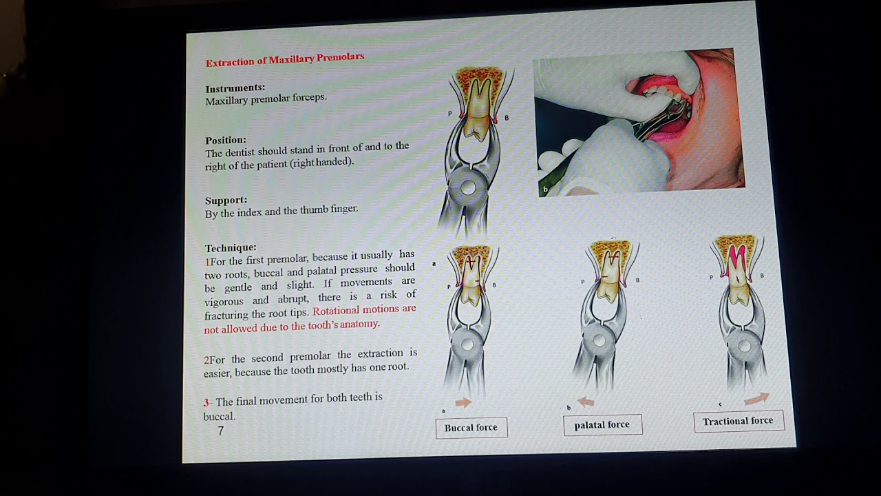 Principles of Exodontia, Lec.7, Oral Surgery# - YouTube