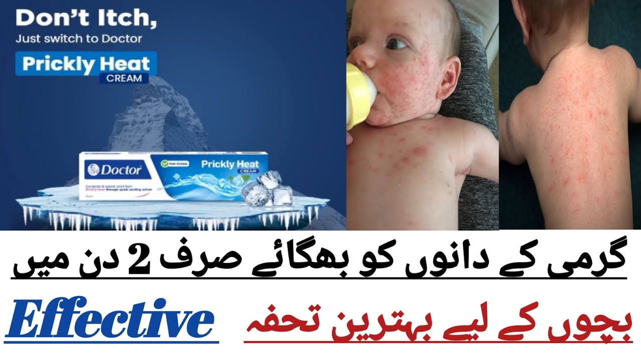 Prickly Heat Cream Review|Doctor Prickly Heat Cream|प्रिकली हीट क्रीम ...