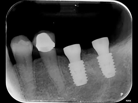Implant Placement LL6 LL7 - YouTube