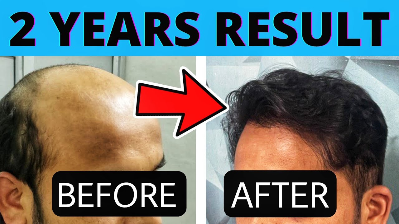 Hair Transplant Result After 2 Years | Hair Transplant In Ranchi ...
