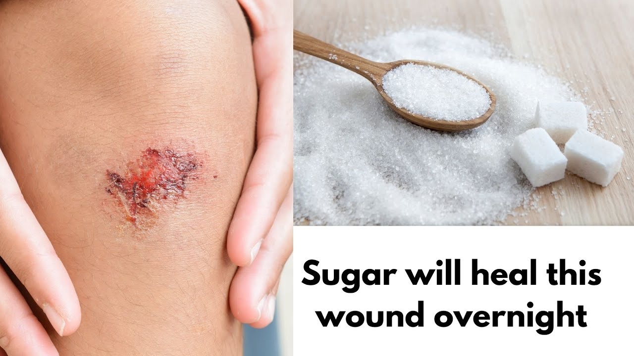 Use sugar to heal wounds overnight - YouTube