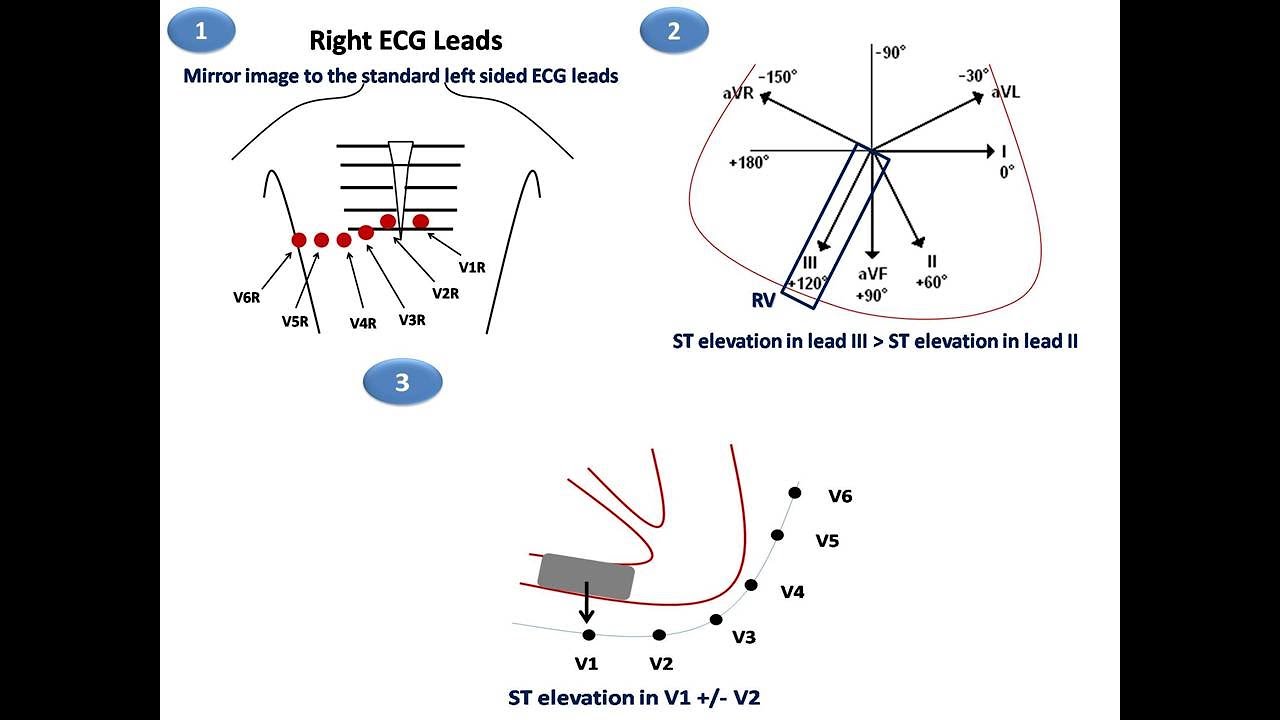 ECG course: RV infarction, Dr. Sherif Altoukhy - YouTube