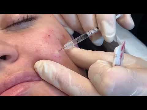 INTRADERMAL BOTOX THERAPY"#beautytricks - YouTube