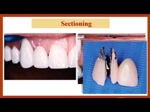 9 Crown Sectioning قسم وقطع التركيبات لازالتها و استبدالها - YouTube