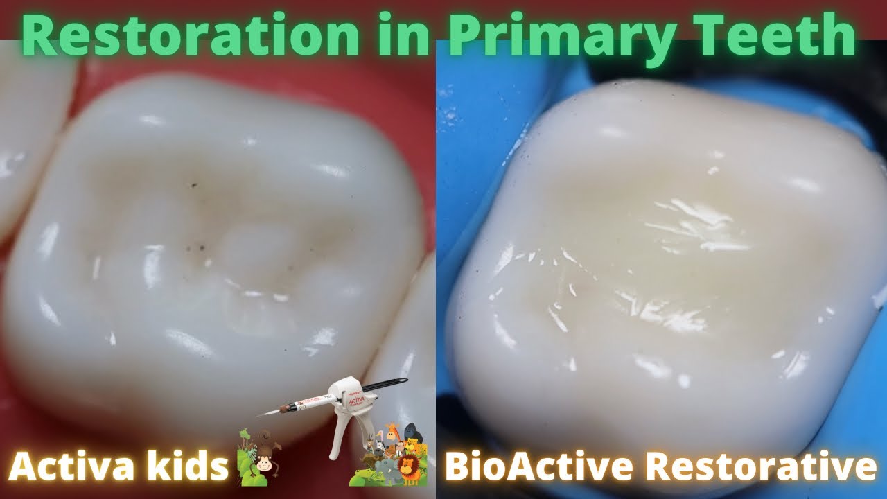 Restoration in Primary Teeth ⚪️ Activa kids BioActive Restorative 🟢 ...