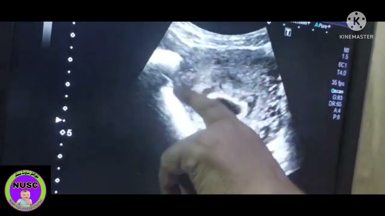 Early Intrauterine Gestational Sac - YouTube
