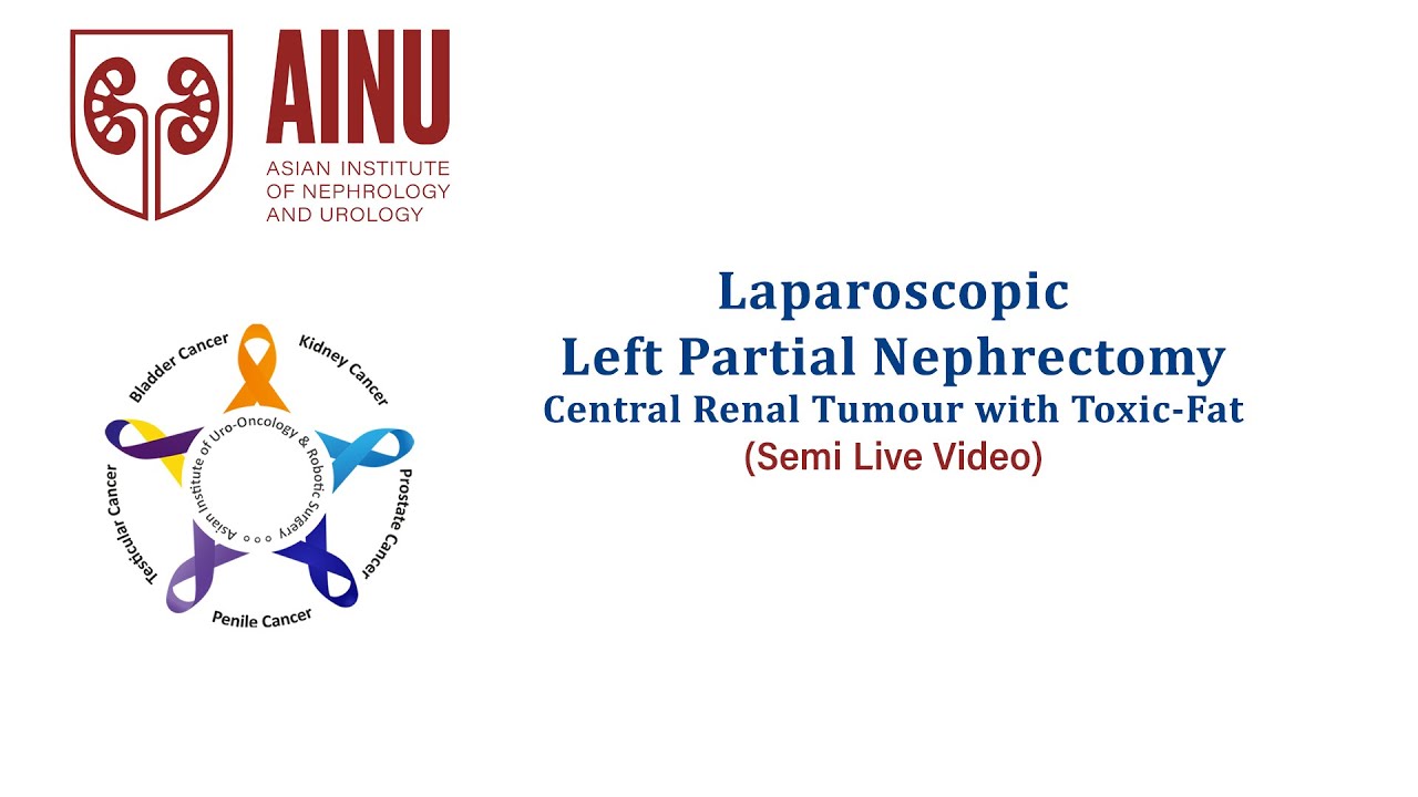 Laparoscopic Left Partial Nephrectomy (Central Renal Tumour with Toxic ...