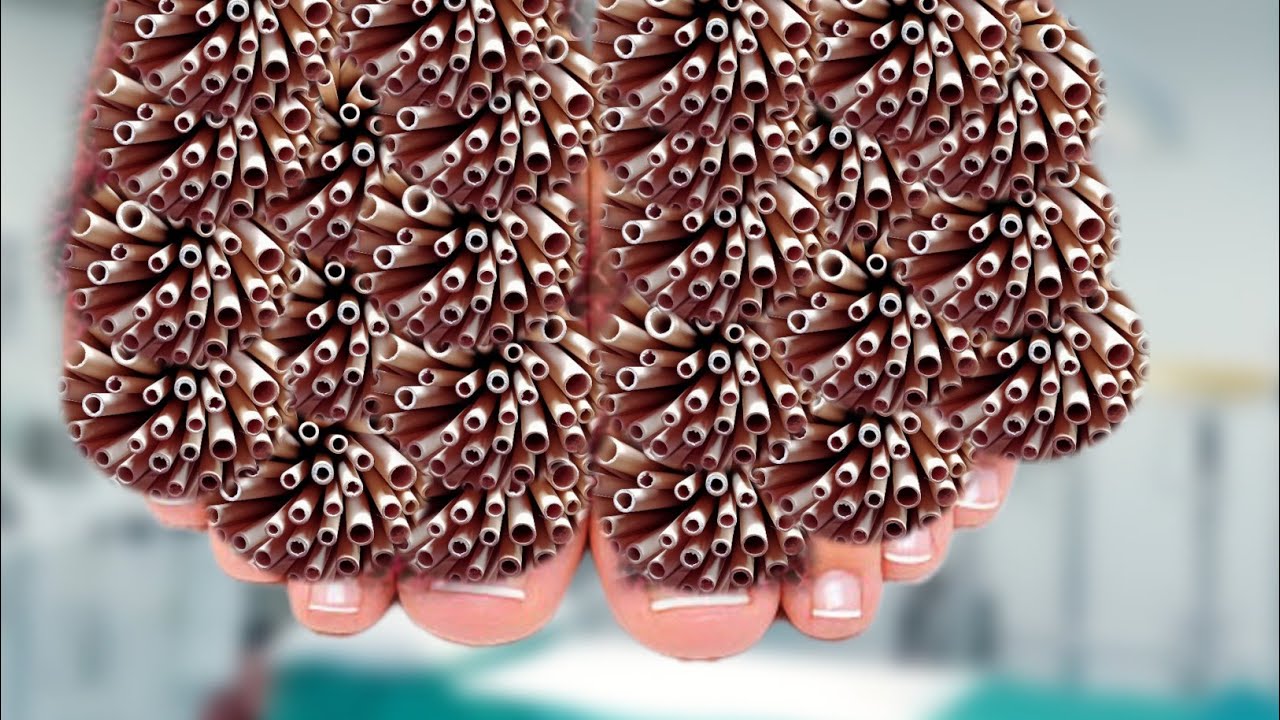 ASMR foot surgery toe feet| ASMR severely infected maggot & trypophobia ...