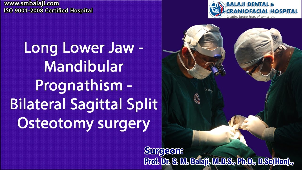Long Lower Jaw - Mandibular Prognathism - Bilateral Sagittal Split ...