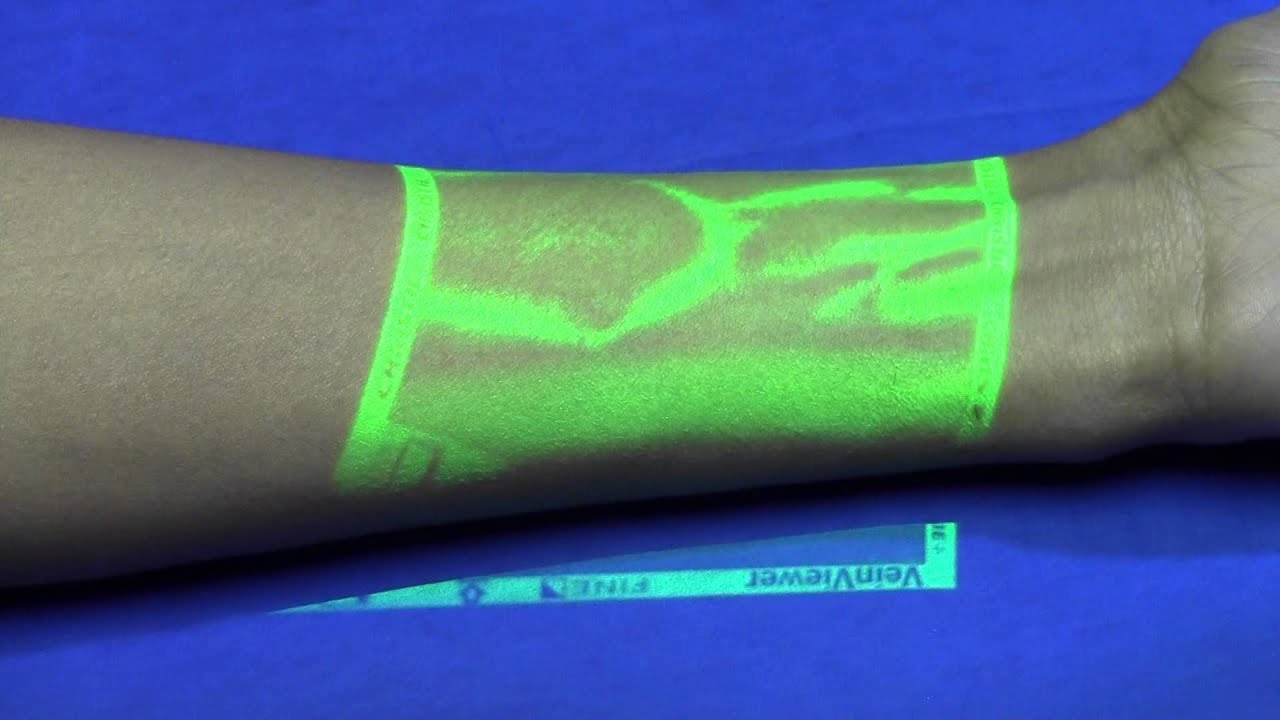 New Veinviewer Imaging Technology - YouTube