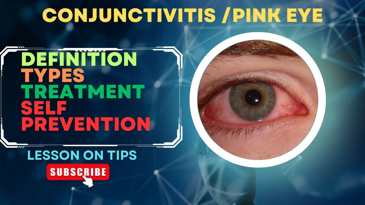 Eye Flu | Conjunctivitis in hindi | Eye Flu Treatment | Conjunctivits ...